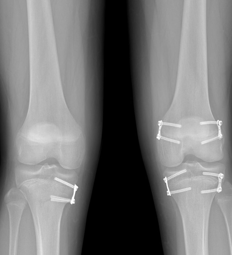 Wachstumskorrektur (Epiphyseodese) von X-Beinen, O-Beinen oder ...